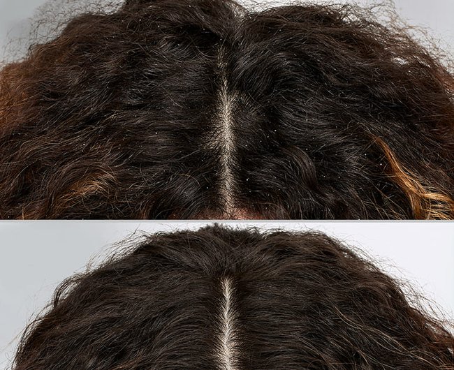 Difference Between Dandruff Treatment in Dry vs Oily Scalp