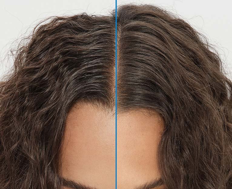 Causes of Greasy Hair: Why Does Hair Get Greasy So Quickly?