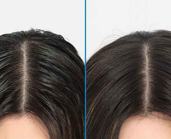 Explore Reasons and Causes for Oily Scalp